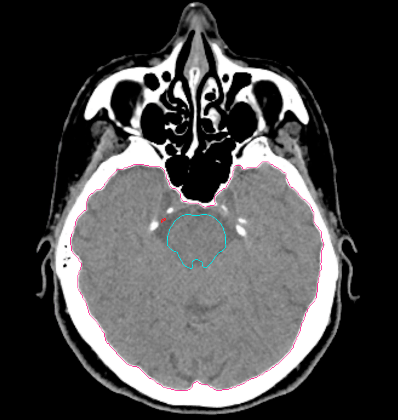 Trigeminal Neuralgia - Accuray