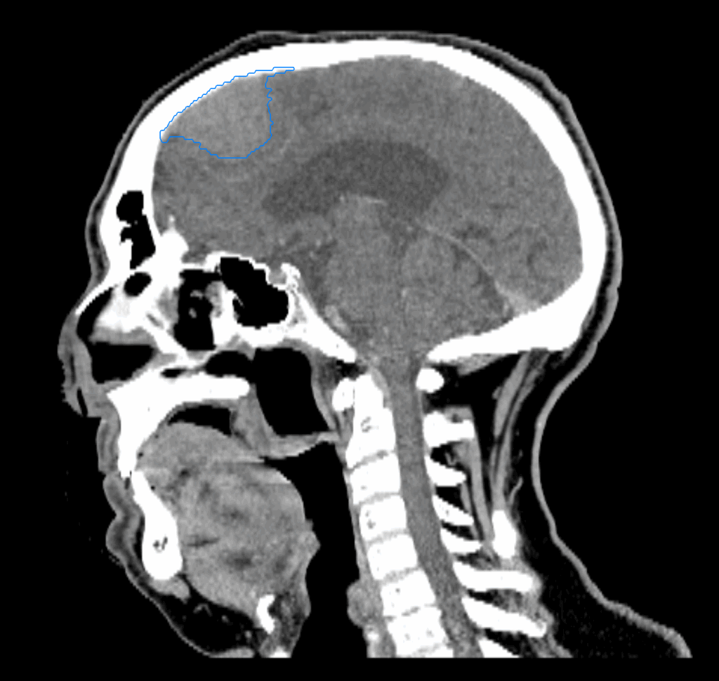 Left Frontal Lobe Meningioma - Accuray