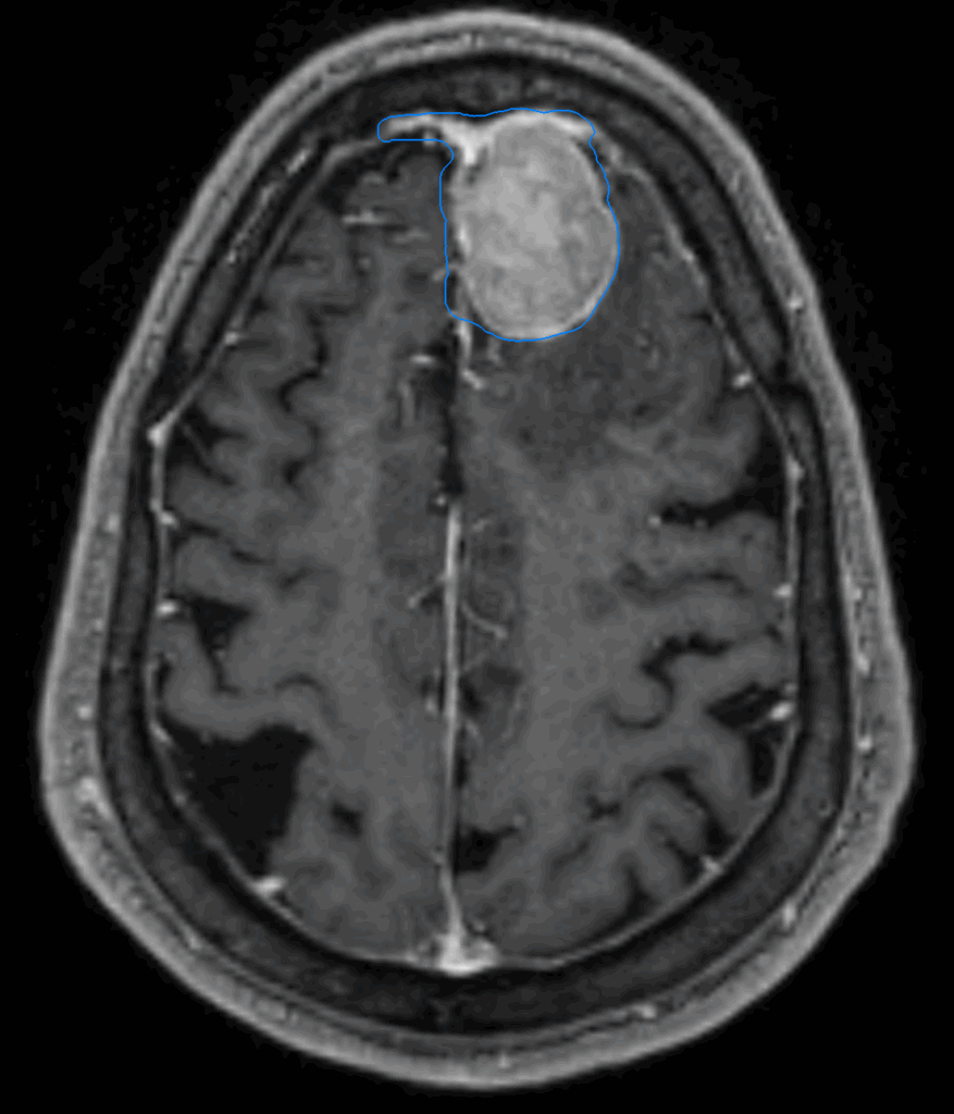 Left Frontal Lobe Meningioma - Accuray