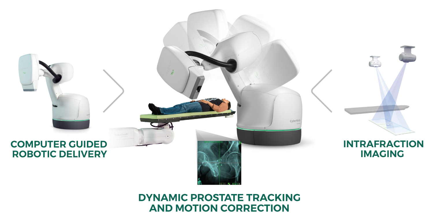 Prostate Sbrt With Cyberknife Precise Innovative Tumor Treatments