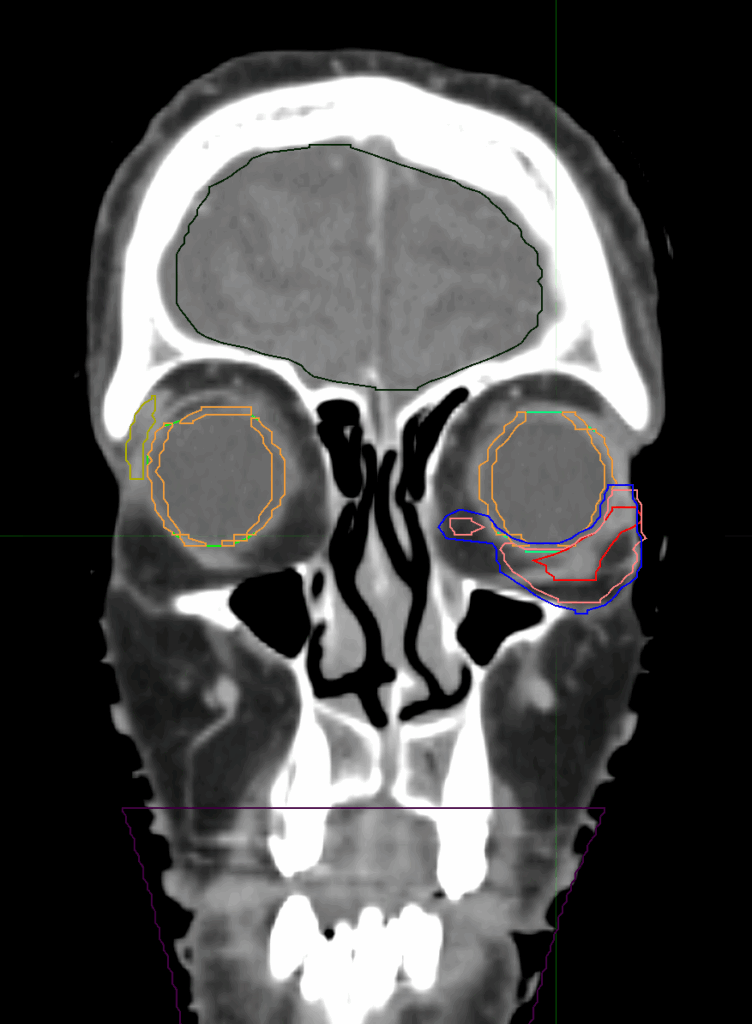 Basal Cell Carcinoma of the Lower Left Eyelid - Accuray