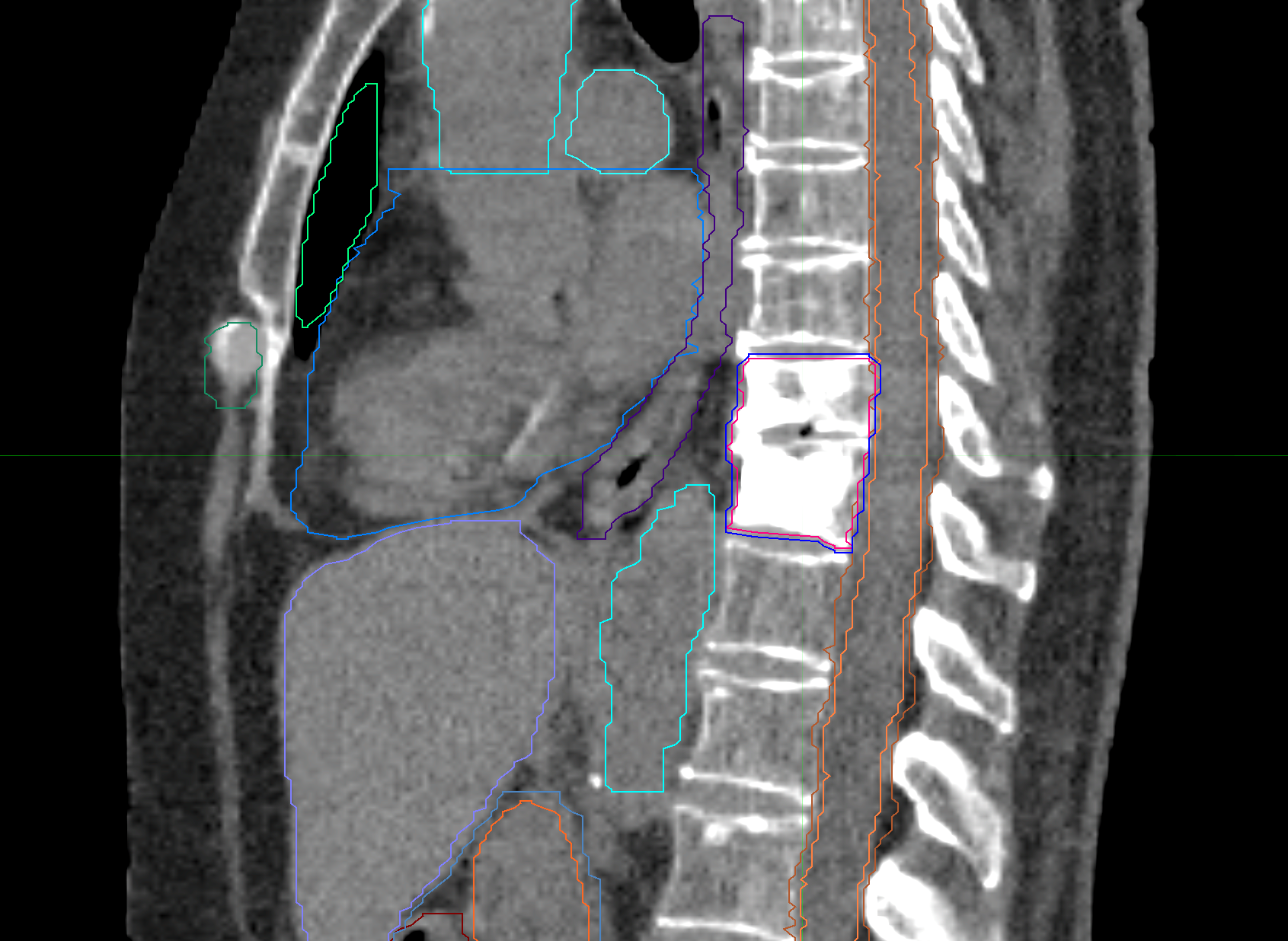 T10-T11 Spine Metastasis - Accuray