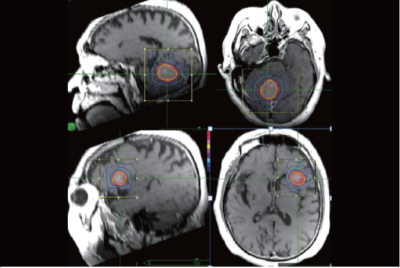 Radiosurgery - Accuray