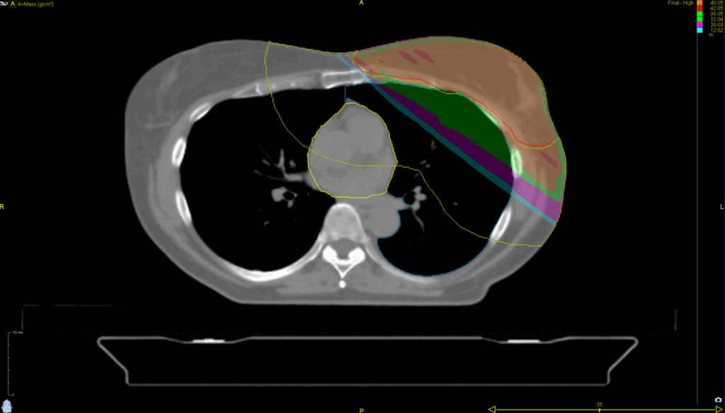 Left Breast with Deep Inspiration Breath Hold - Accuray