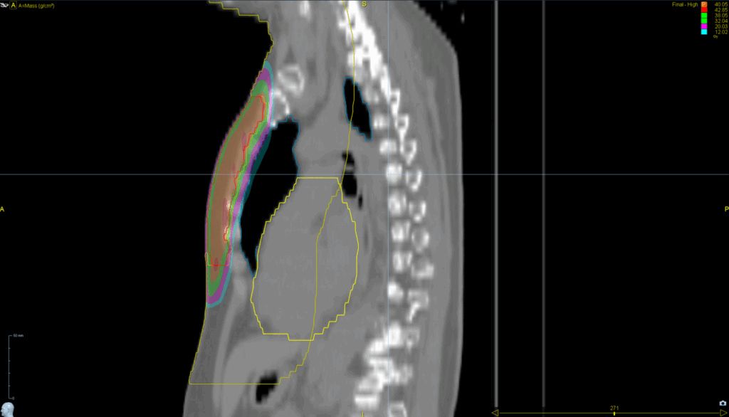 Left Breast with Deep Inspiration Breath Hold - Accuray