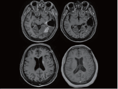 Radiosurgery - Accuray