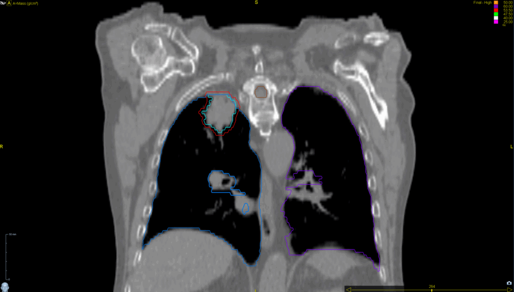 Lung SBRT with Synchrony® Lung with Respiratory Tracking Modeling - Accuray