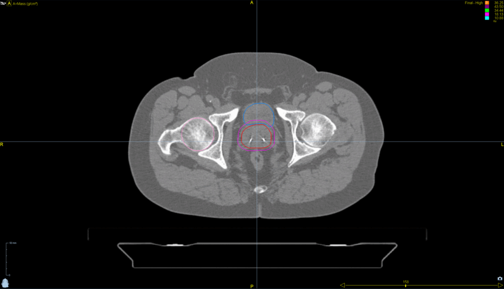 Prostate SBRT with Synchrony® Fiducial Tracking™ - Accuray