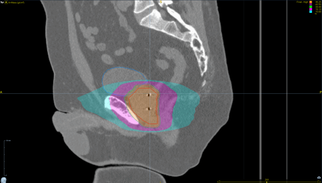 Prostate SBRT with Synchrony® Fiducial Tracking™ - Accuray