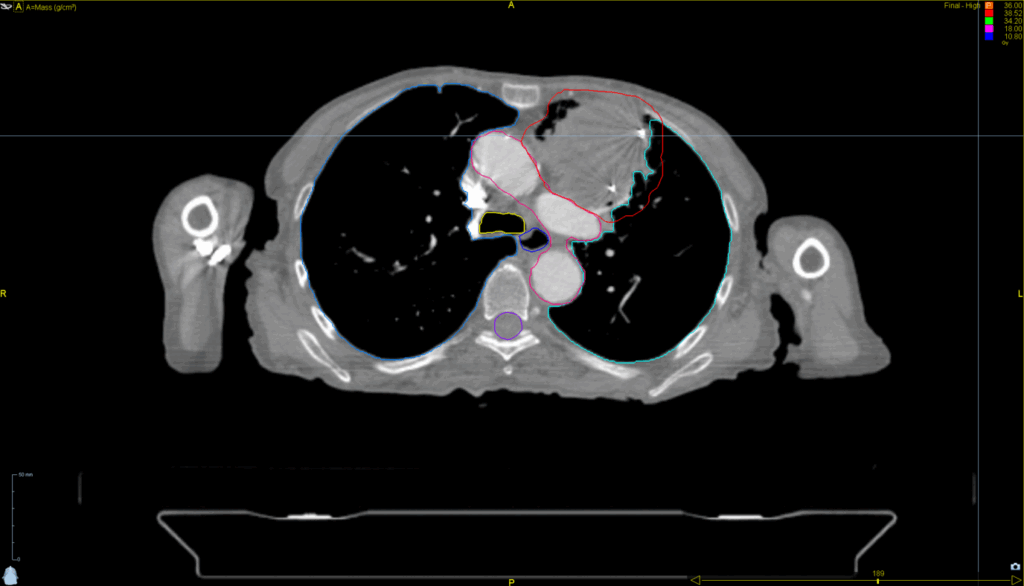 Lung SBRT with Synchrony® Fiducial Tracking™ and Respiratory Modeling ...