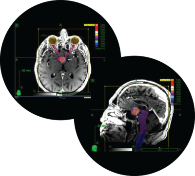 Radiosurgery - Accuray