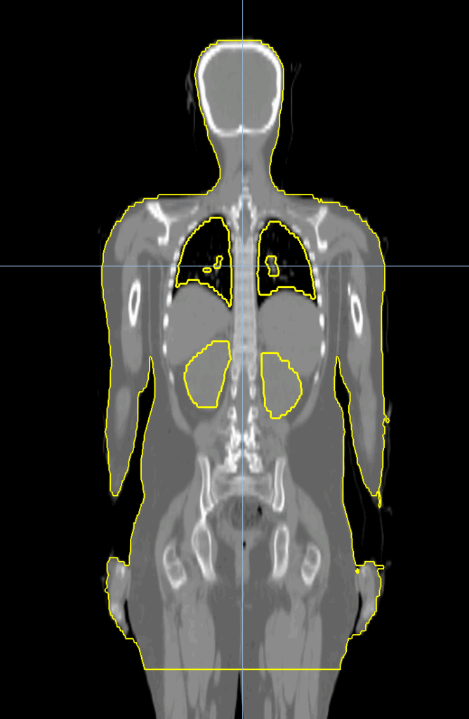 Total Body Irradiation - Accuray