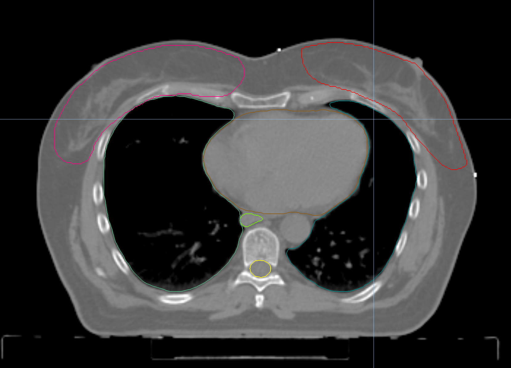 Bilateral Breast with SIB and Nodes with Single Isocenter - Accuray