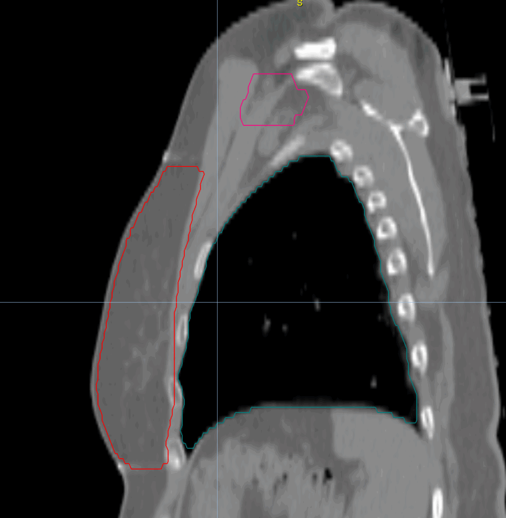Complex Left Breast SIB and Nodes - Accuray