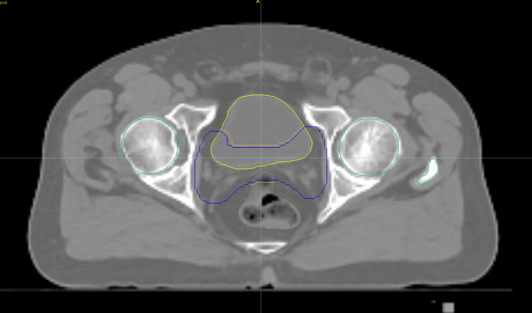 Prostate Bed - Accuray