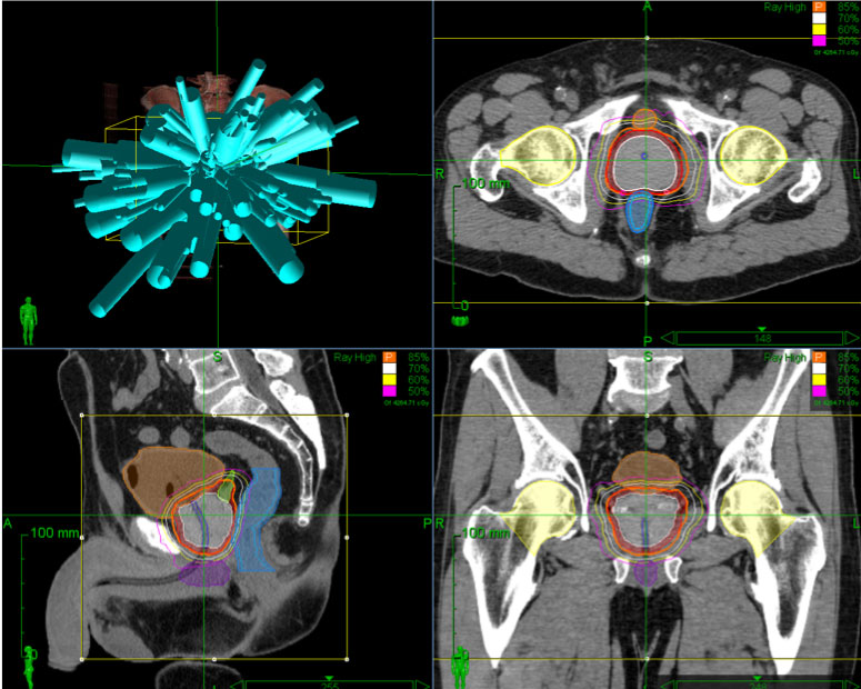 Prostate Srbt Treatment With Cyberknife Accuray